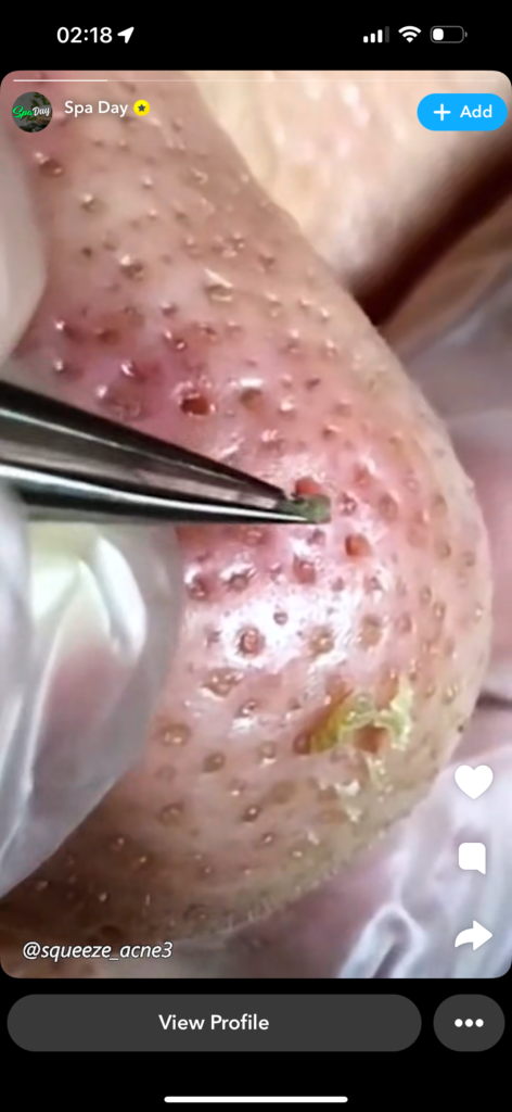 A close-up of skin, possibly from an extraction process like acne or ...