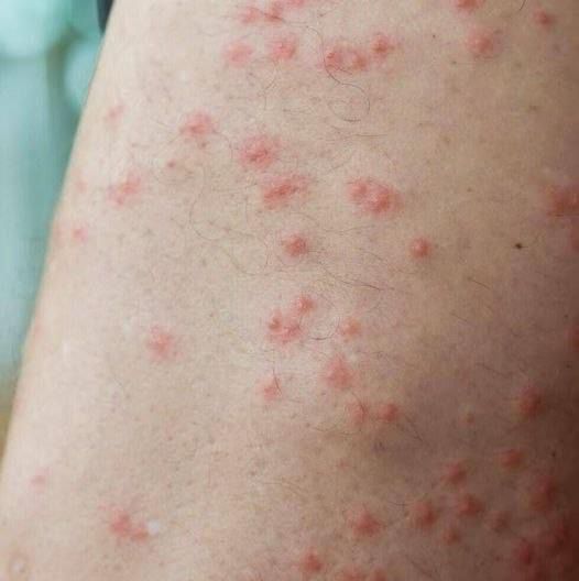 How To Identify 10 Of The Most Common Bug Bites - My Healthy Life