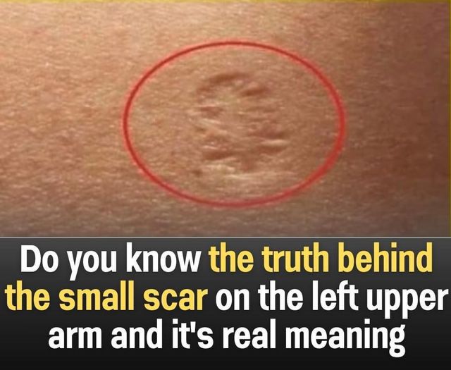 True Meaning Behind the Tiny Scar on Your Upper Left Arm!” - My Healthy ...
