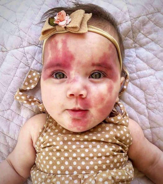 Baby called ‘hideous’ is a gorgeous little girl now - My Healthy Life