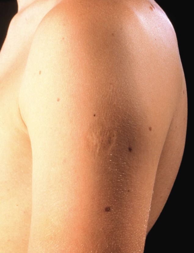 Uncategorized Smallpox vaccine scars: What they look like and why - My ...
